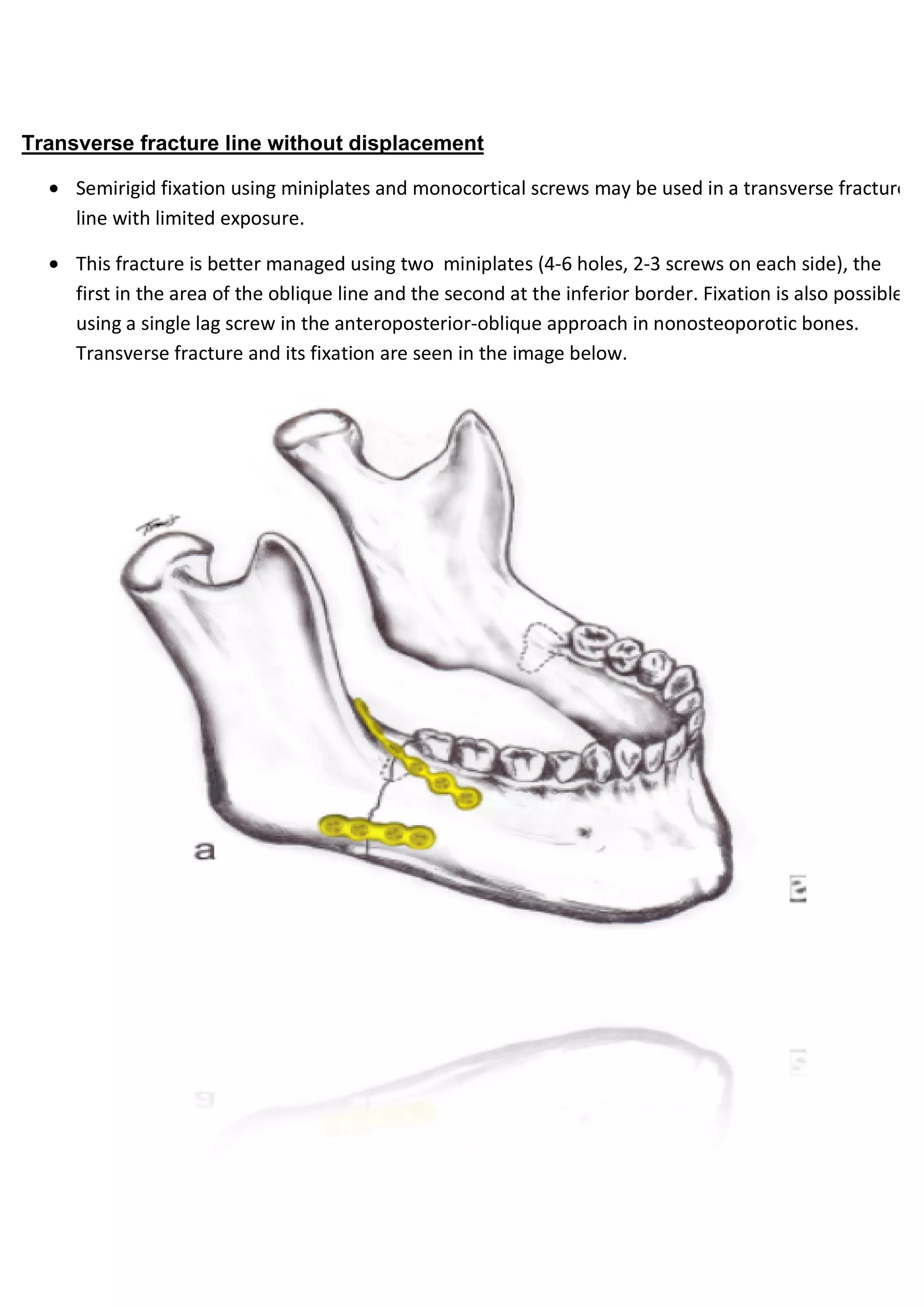 Symphysis & Angle MANDIBULAR FRACTURES | PDF