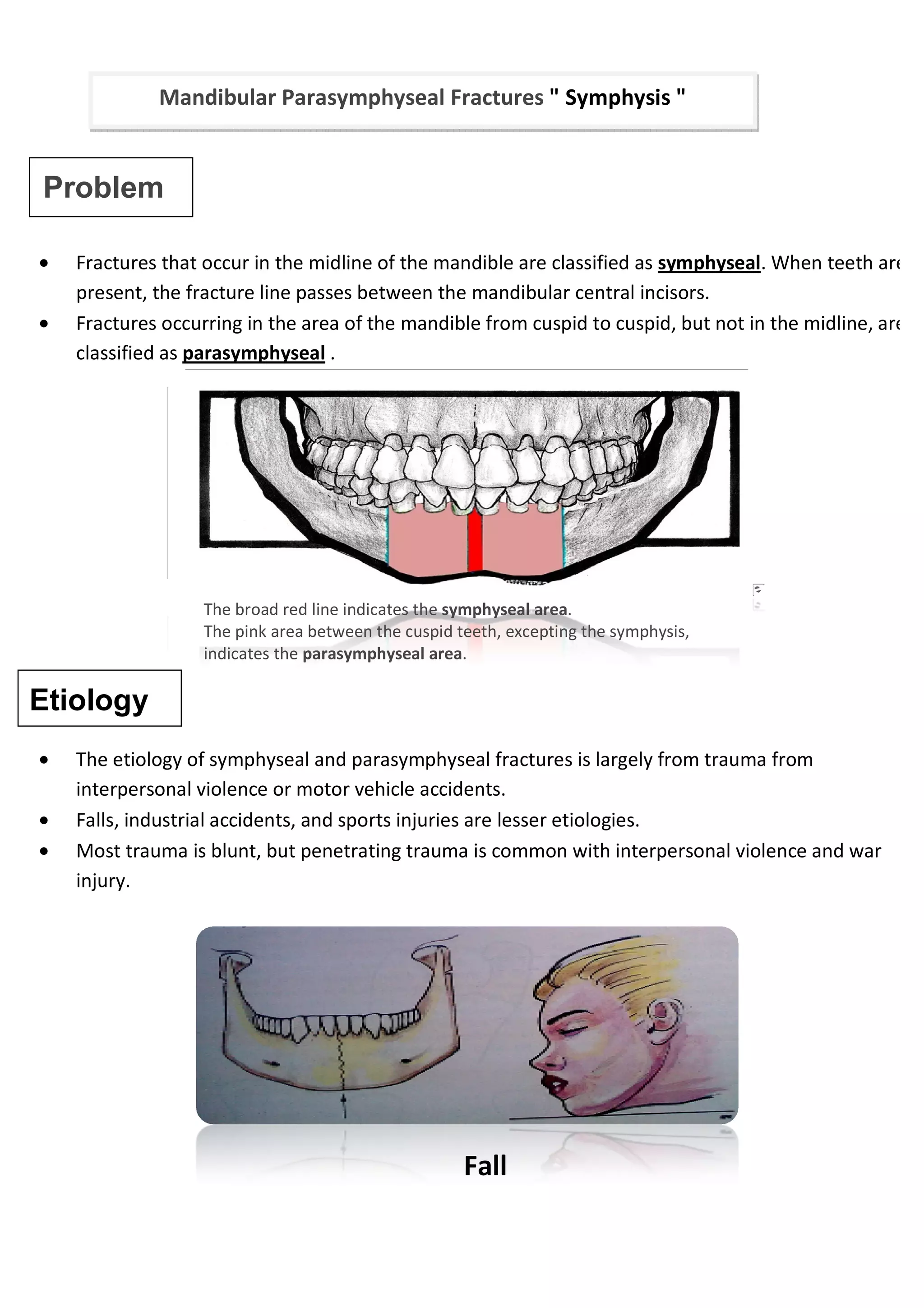Symphysis & Angle MANDIBULAR FRACTURES | PDF