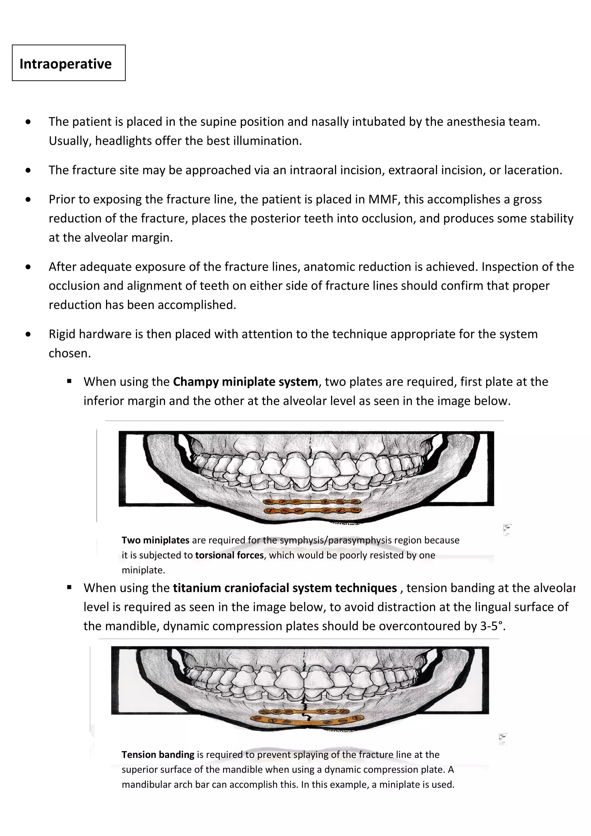 Symphysis & Angle MANDIBULAR FRACTURES | PDF