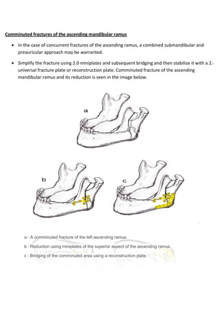 Symphysis & Angle MANDIBULAR FRACTURES | PDF