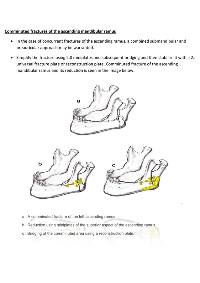 Symphysis & Angle MANDIBULAR FRACTURES | PDF | Death, Injury, or ...