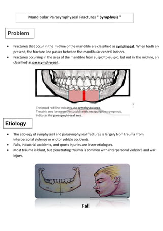 Symphysis & Angle MANDIBULAR FRACTURES | PDF