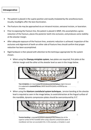 Symphysis & Angle MANDIBULAR FRACTURES | PDF