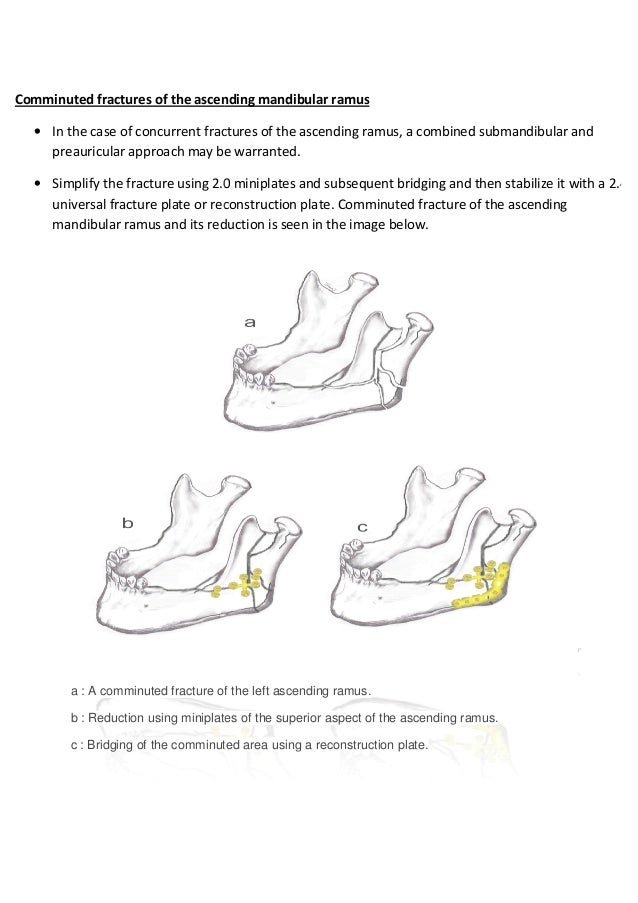 Symphysis & Angle MANDIBULAR FRACTURES