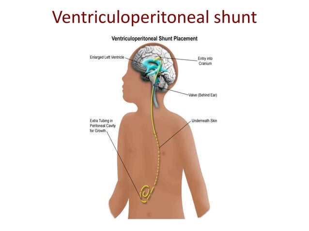Elective neurosurgery | PPT