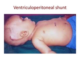 Elective neurosurgery | PPT