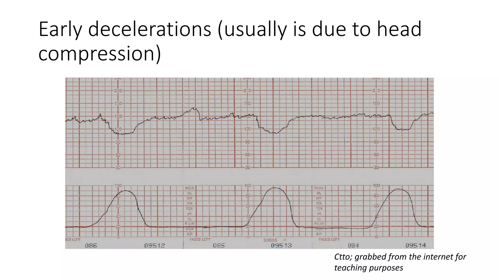 electonic-fetal-monitoring-sgd.pdf