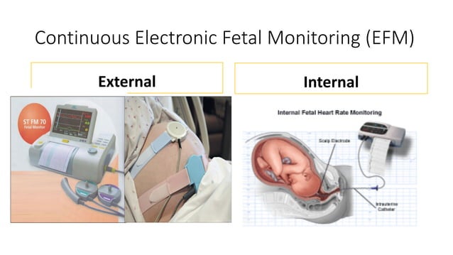 electonic-fetal-monitoring-sgd.pdf