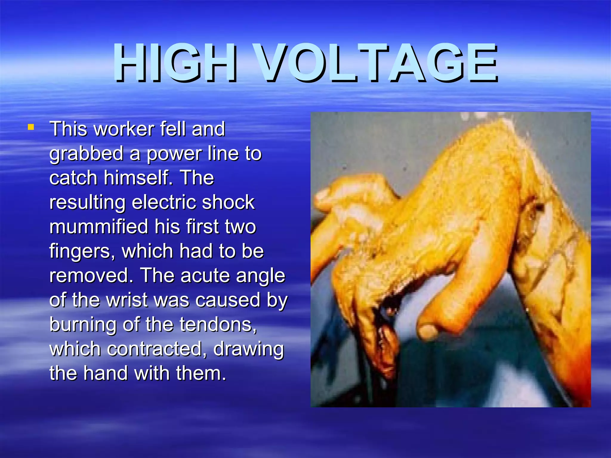 Electrical Injuries | PPT