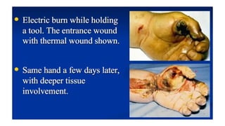 Electrical Burn Injury.pptx plastic surgery | PPTX