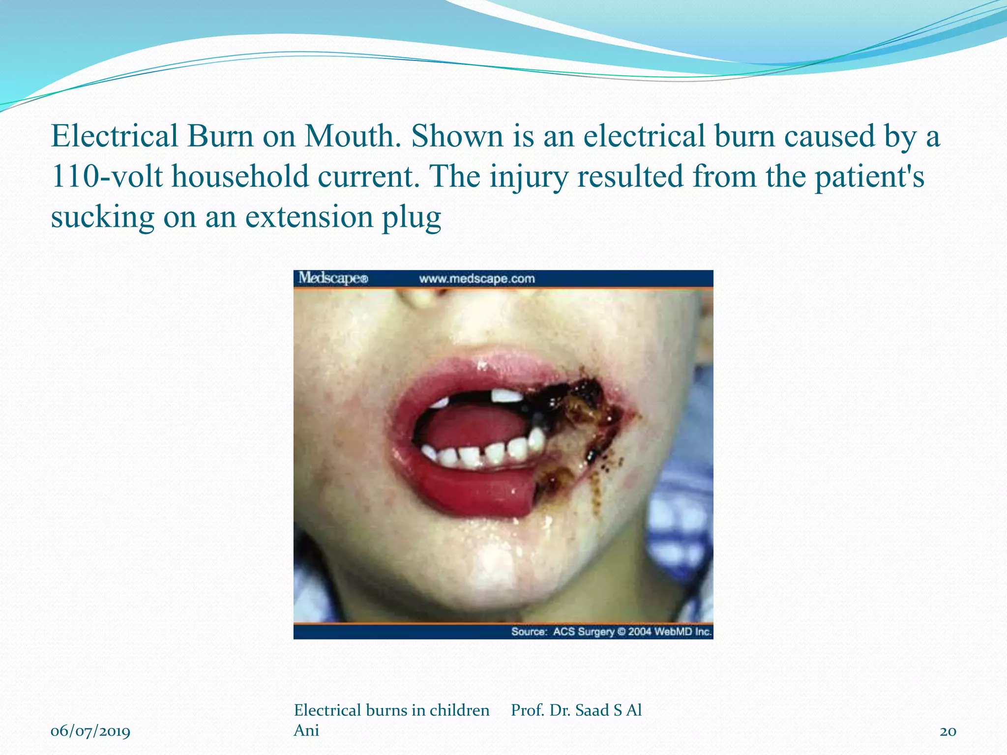 Electrical burns in children | PPTX