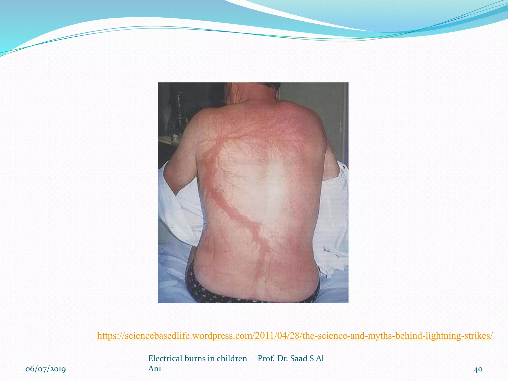 Electrical burns in children | PPTX