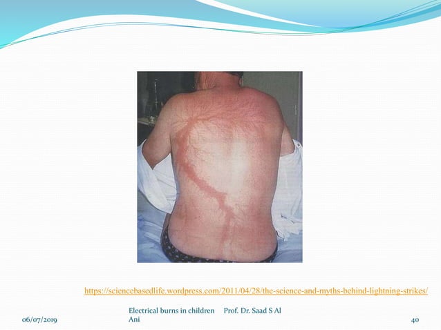 Electrical burns in children | PPTX | First Aid | Injuries