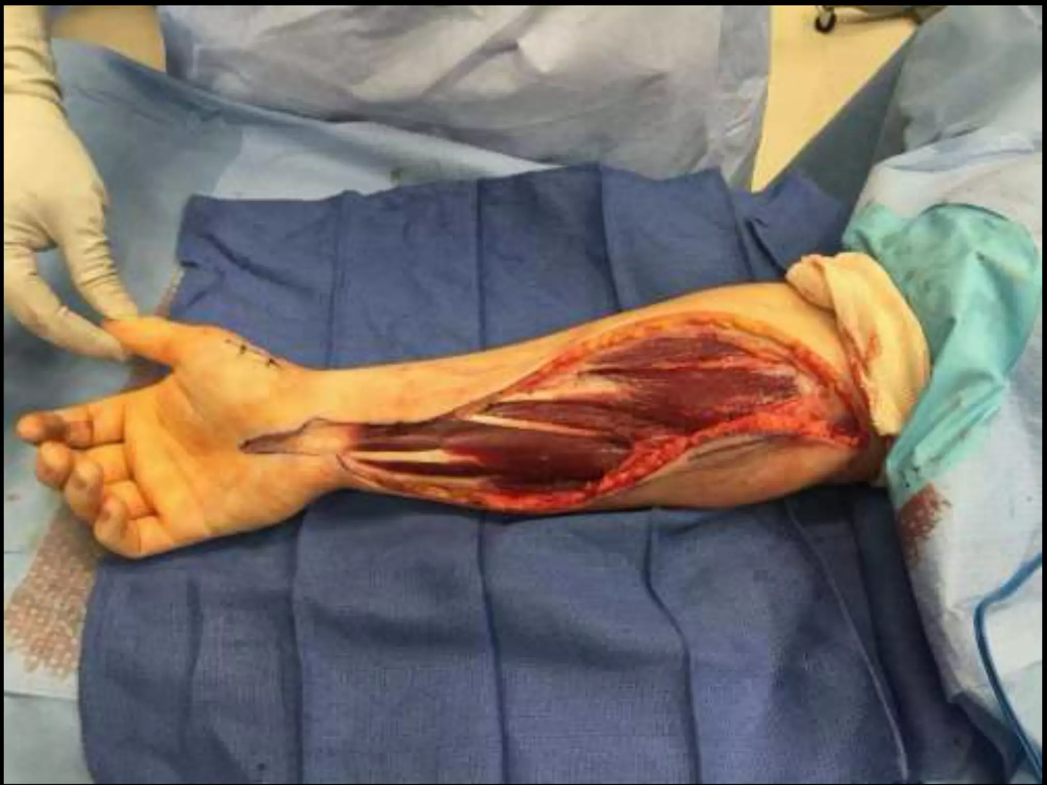 Electrical injury and burn | PPTX