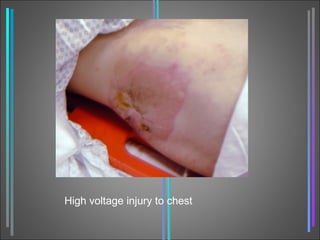 Electrical injuries | PPT