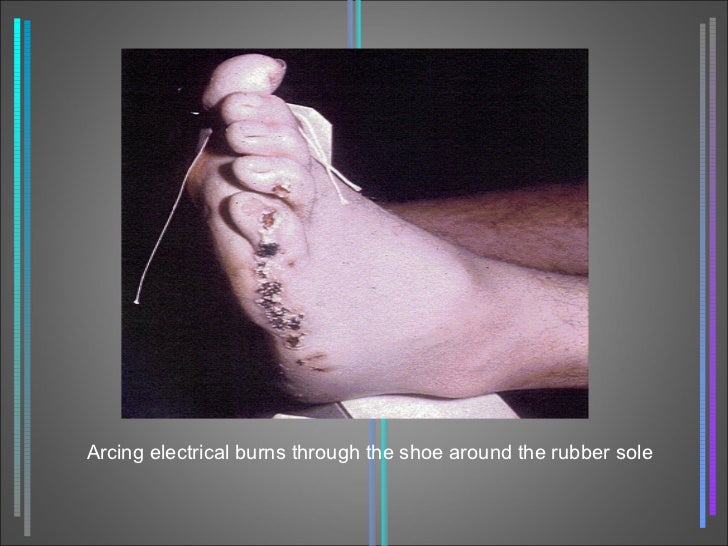Electrical injuries