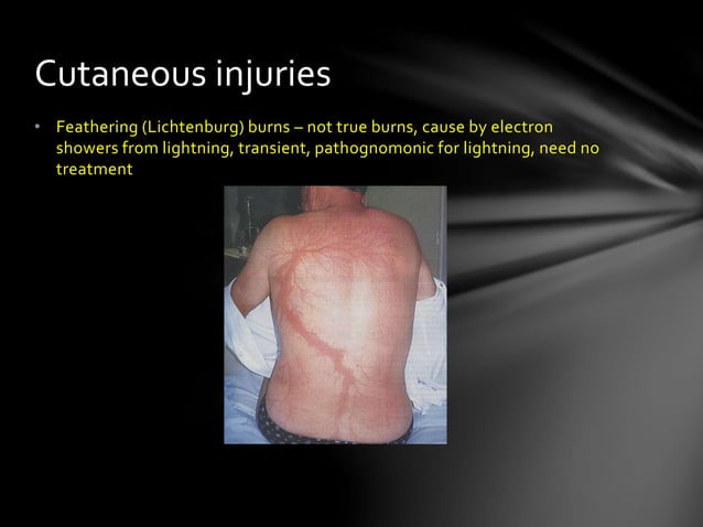 Electrical injuries | PPT