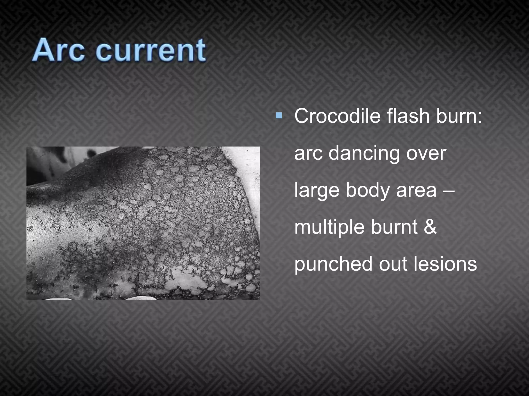 Electrical injuries Dr Ashutosh | PPTX