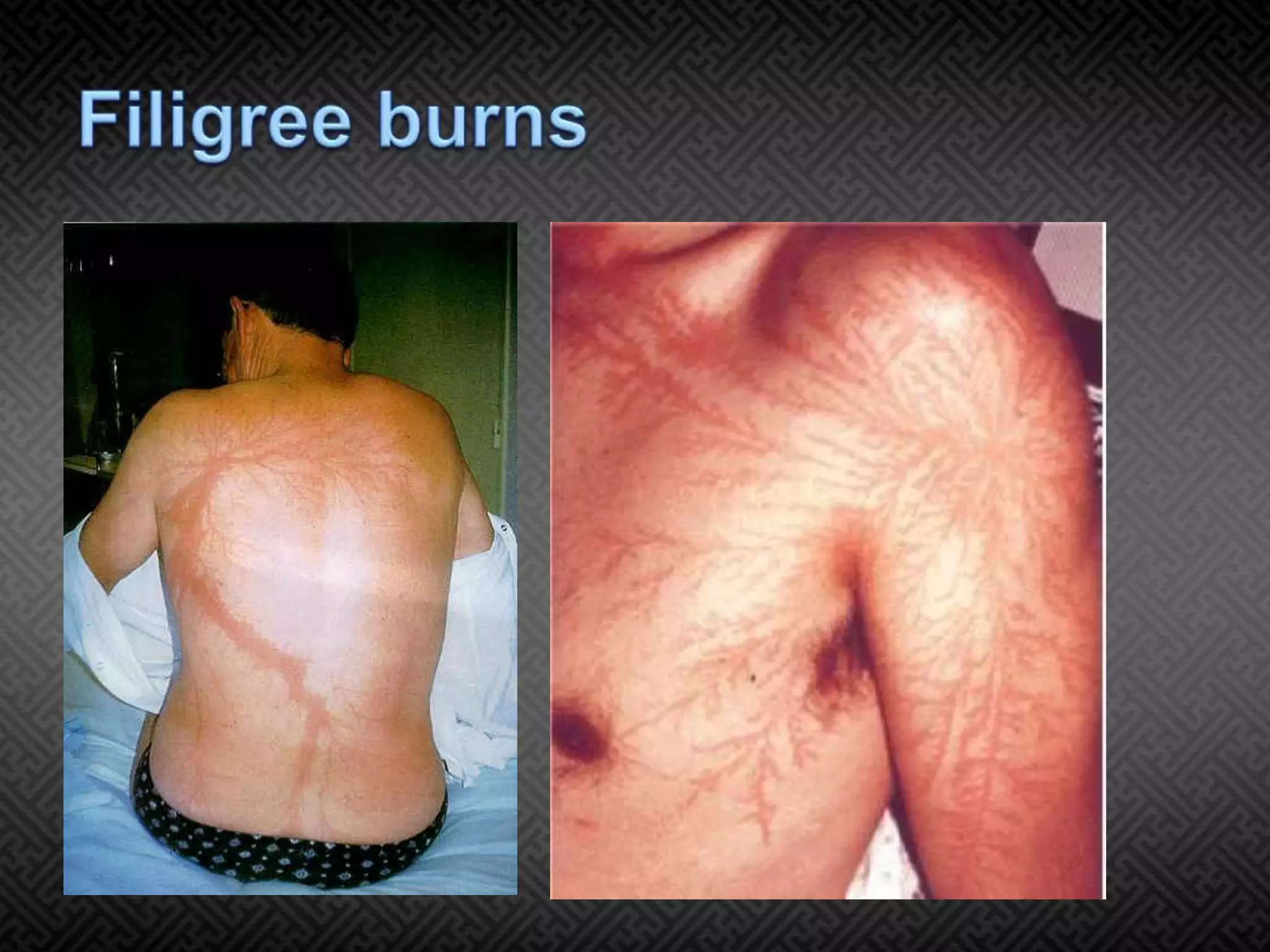 Electrical injuries Dr Ashutosh | PPTX