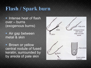 Electrical injuries Dr Ashutosh | PPTX | First Aid | Injuries