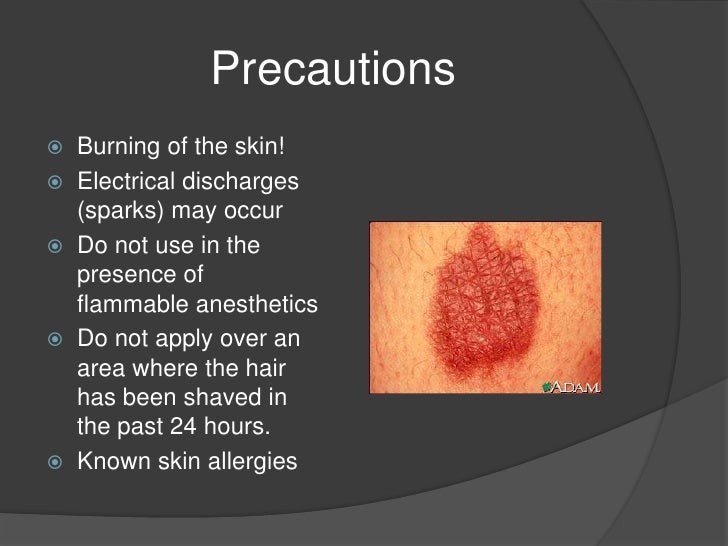 Electrical Modalities