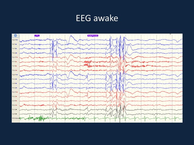 Electrical status beyond convulsive status epilepticus | PPT