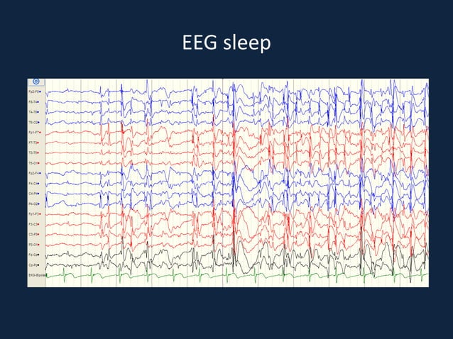 Electrical status beyond convulsive status epilepticus | PPT