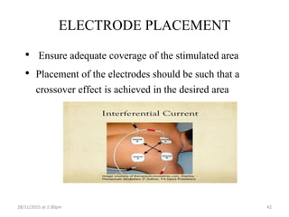 E Stim Electrode Placement