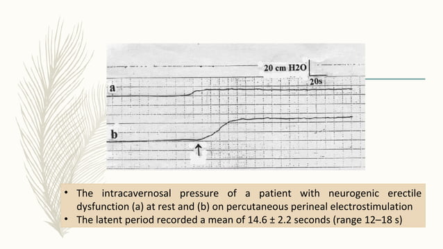 Electrical stimulation for erectile dysfunction | PPT | Sexual ...