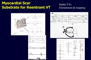 Electrical storm timing and approach for ablation | PPT