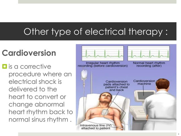 Electrical therapies in cpr | PPTX