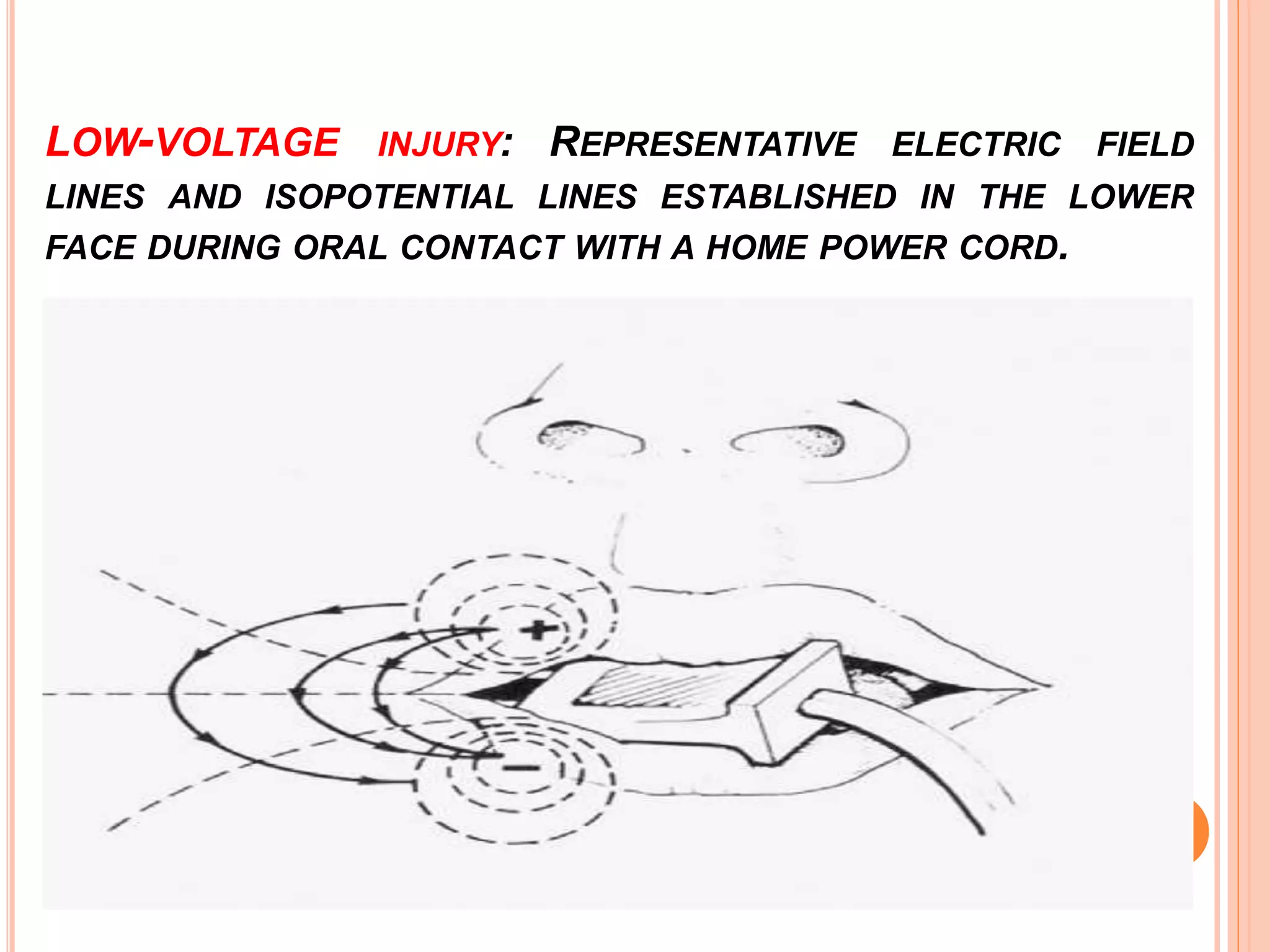 Electric burn | PPTX