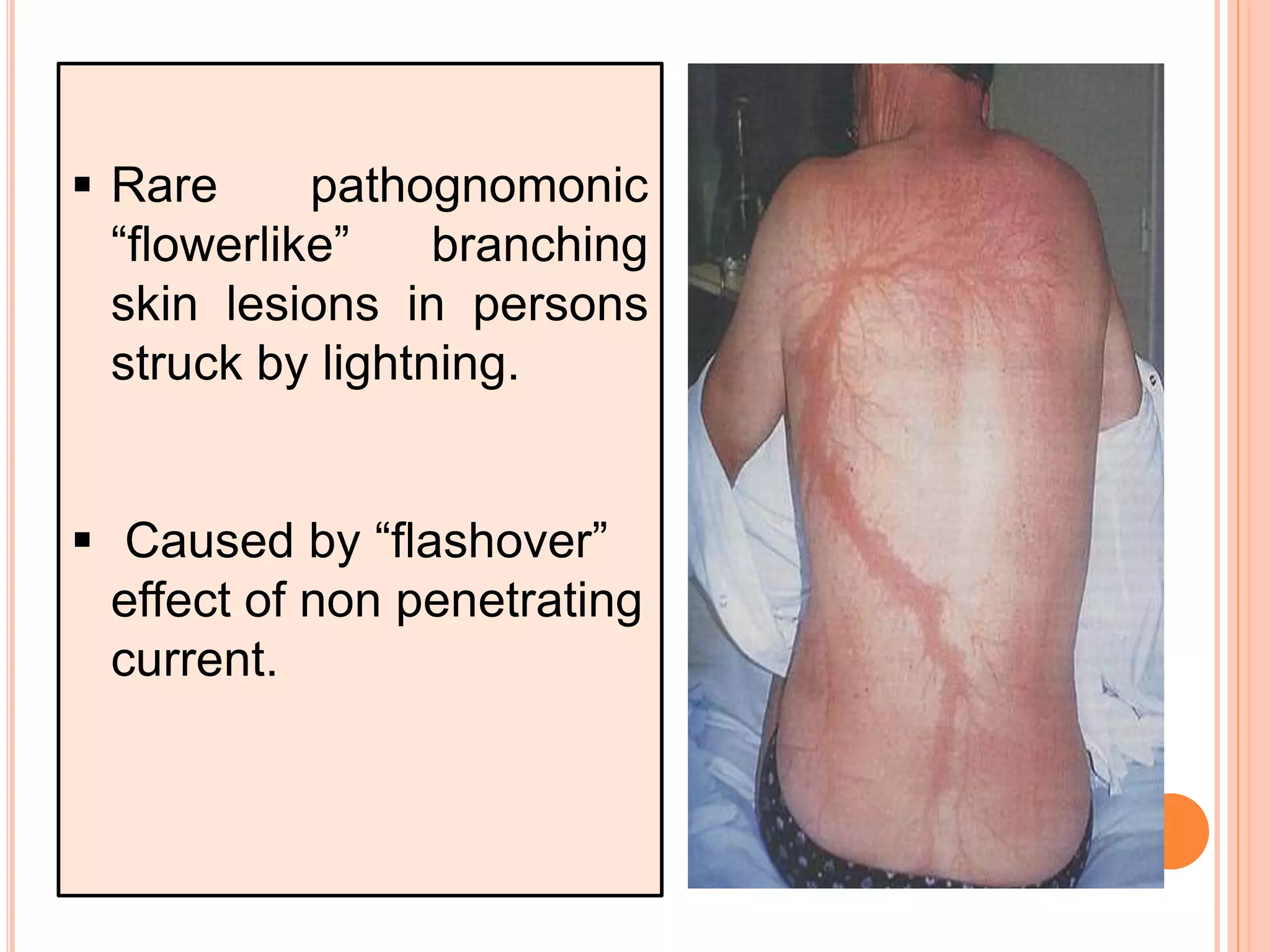 Electric burn | PPTX