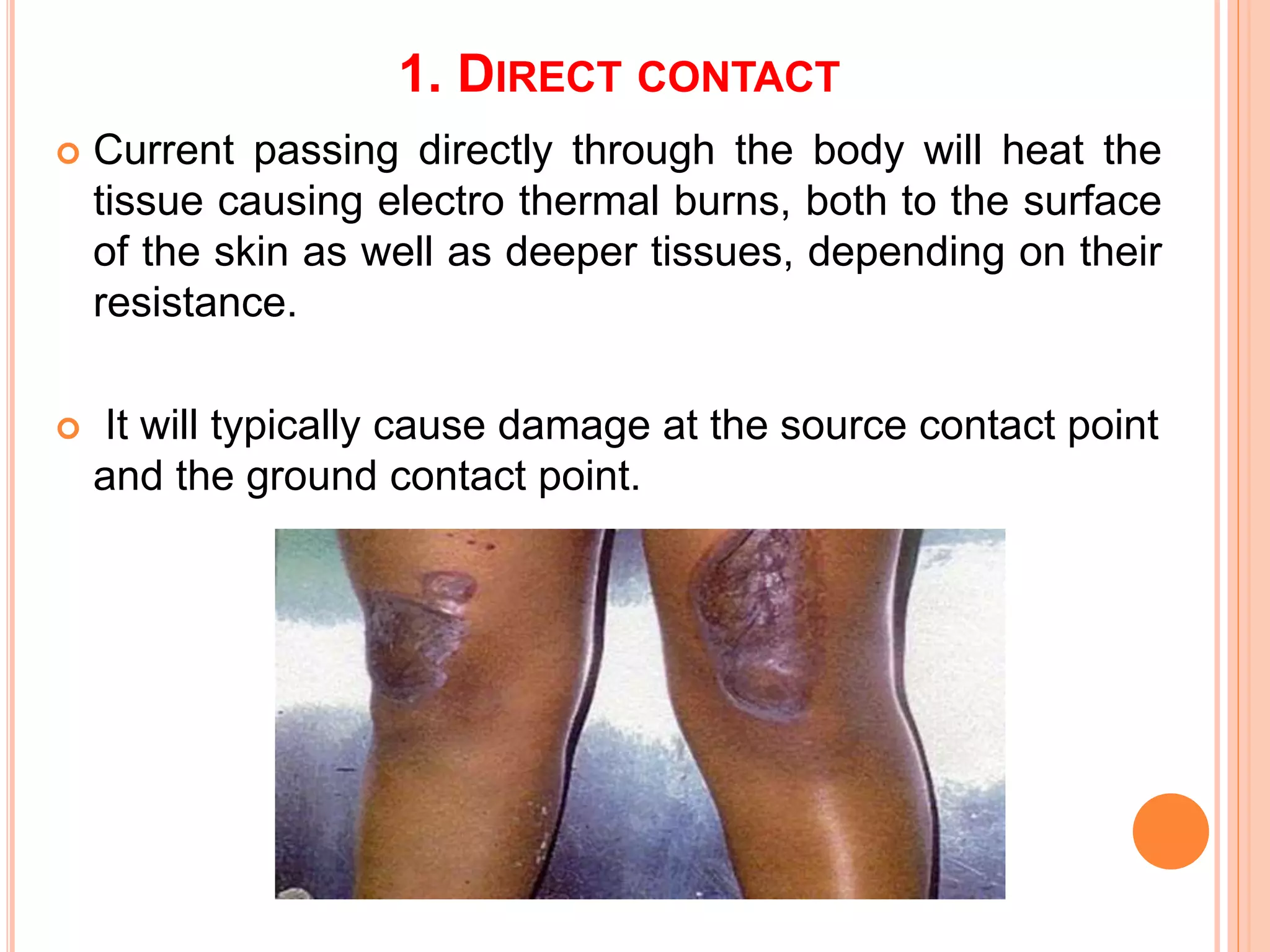 Electric burn | PPTX