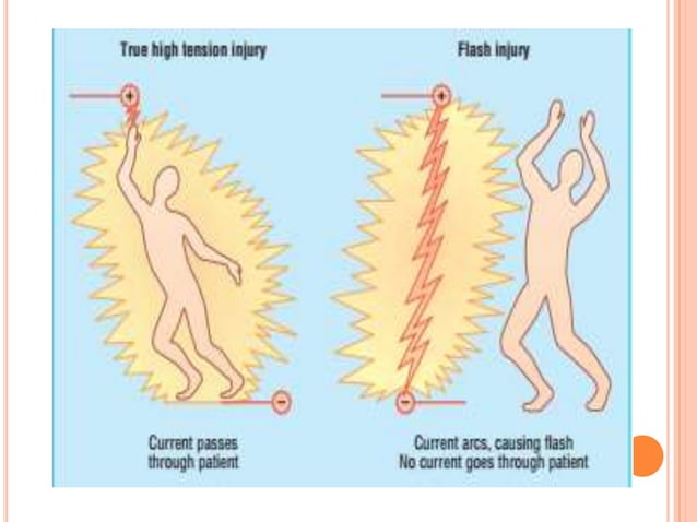 Electric burn | PPTX