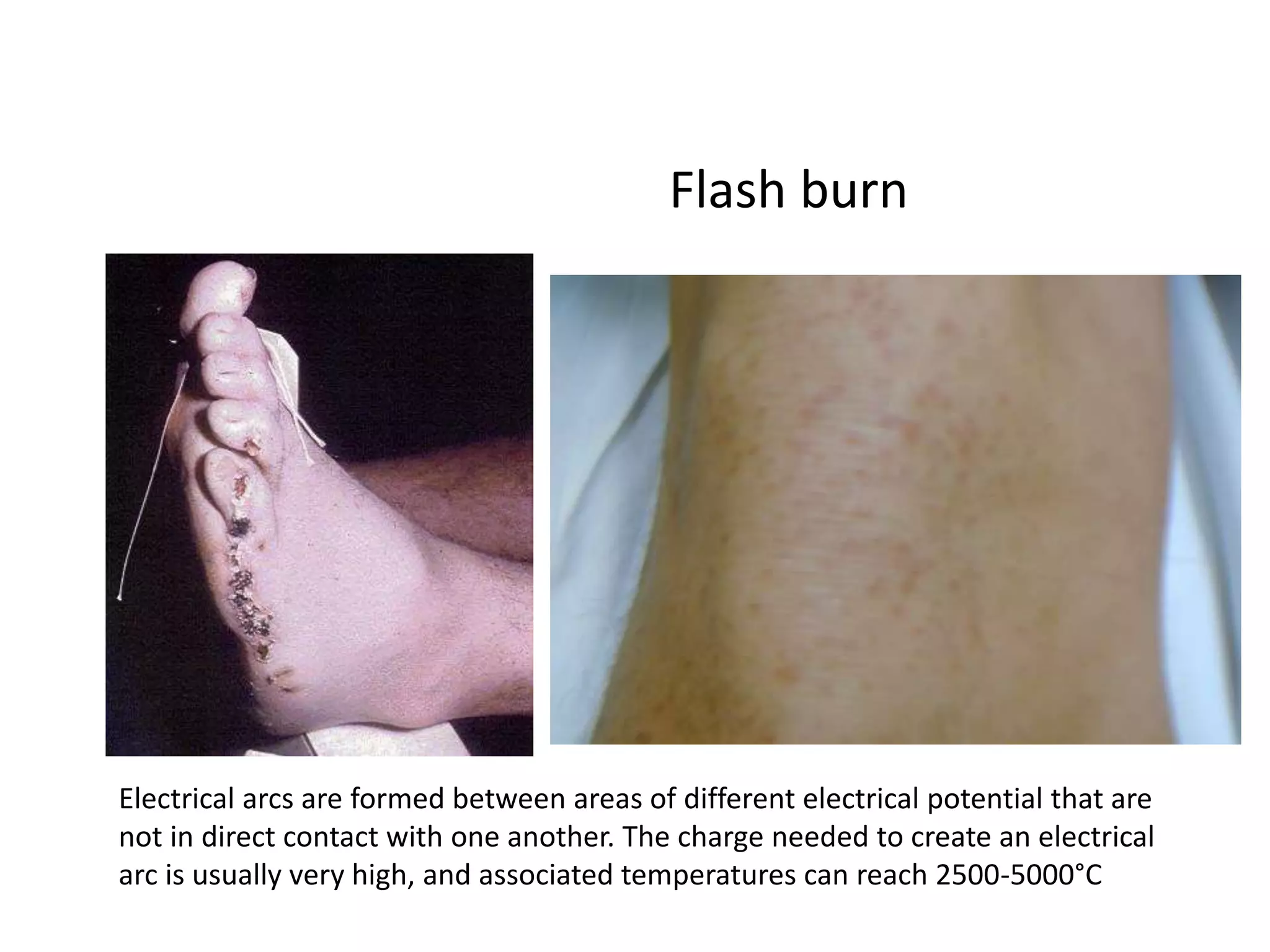 Electric burn injury- diagnosis and management | PPTX