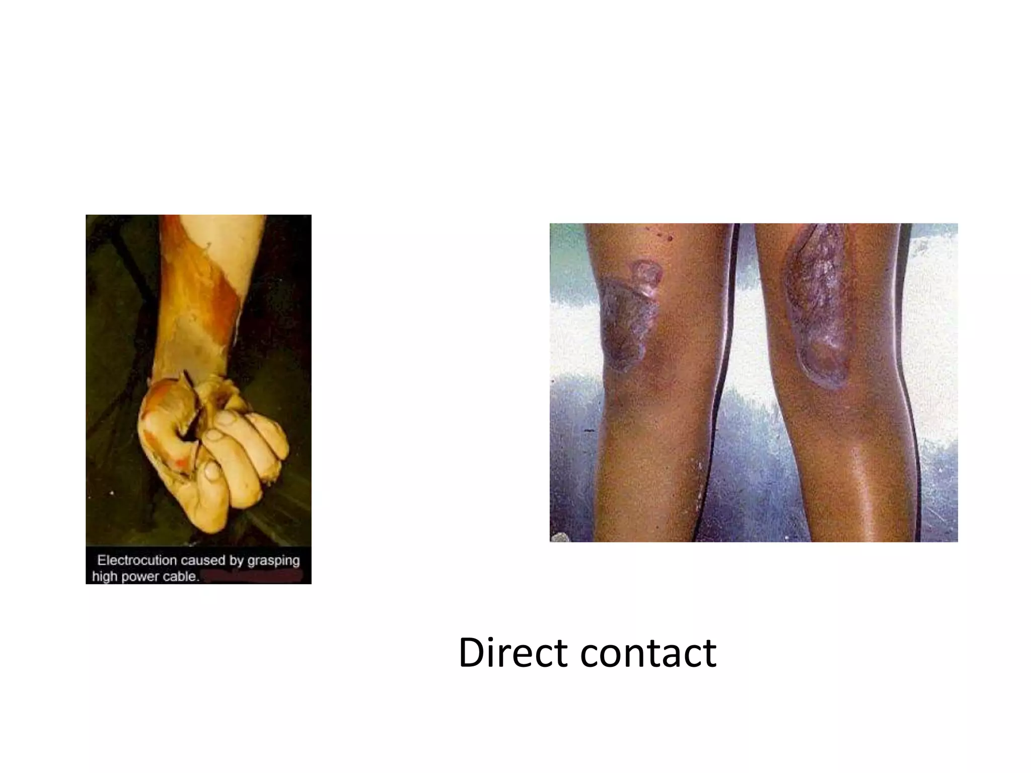 Electric burn injury- diagnosis and management | PPTX