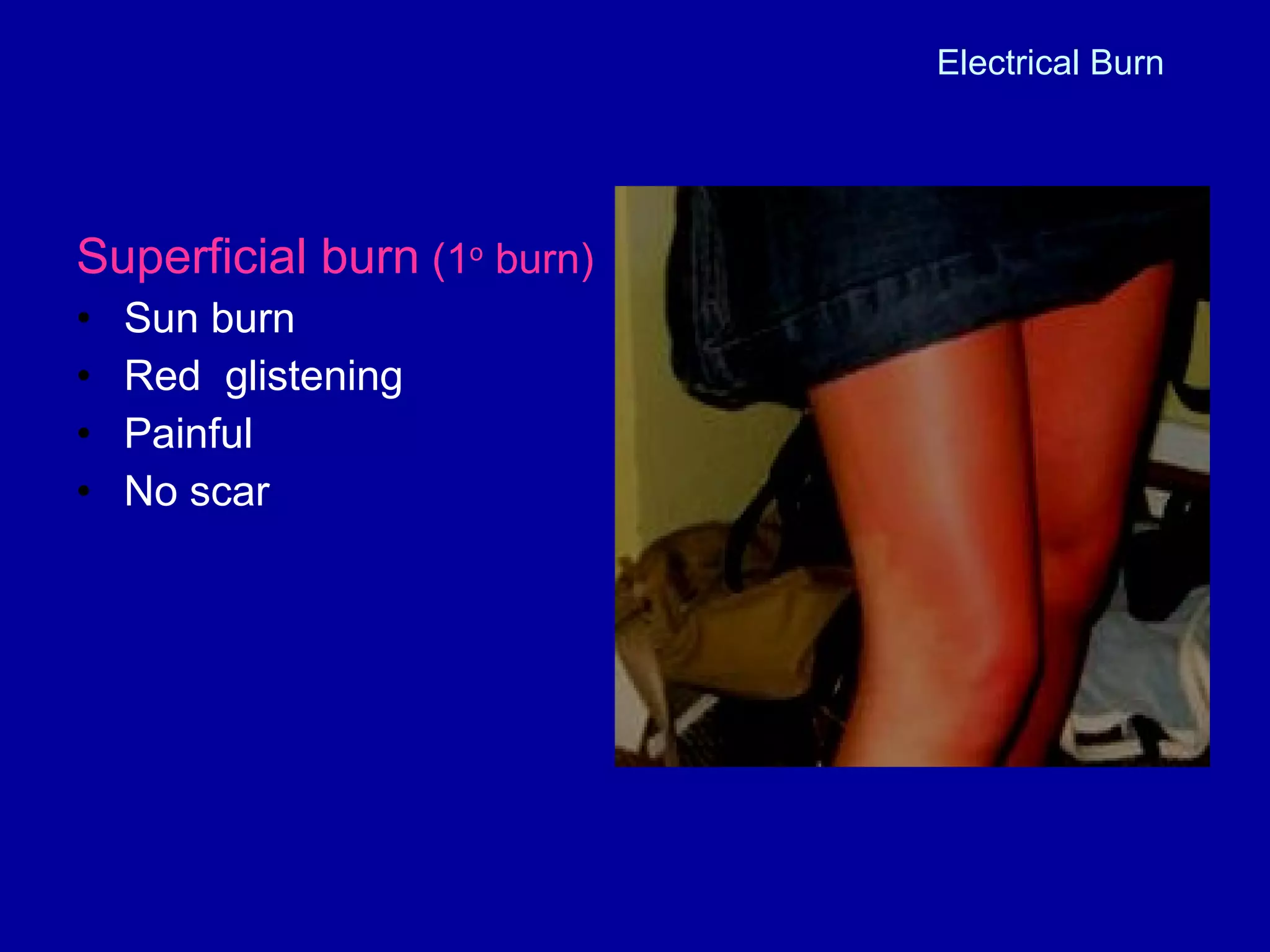 Electric Burn | PPT