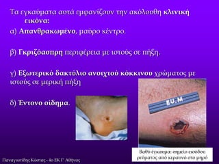 Ηλεκτρικά εγκαύματα - Ηλεκτροπληξία | PPTX