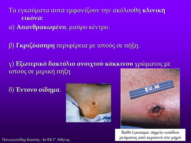 Ηλεκτρικά εγκαύματα - Ηλεκτροπληξία | PPTX