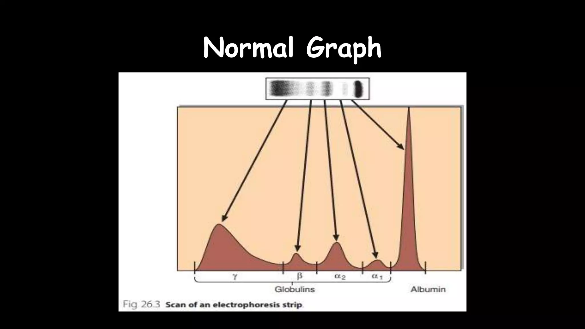 Interpretation of Serum Electrophoresis | PPTX