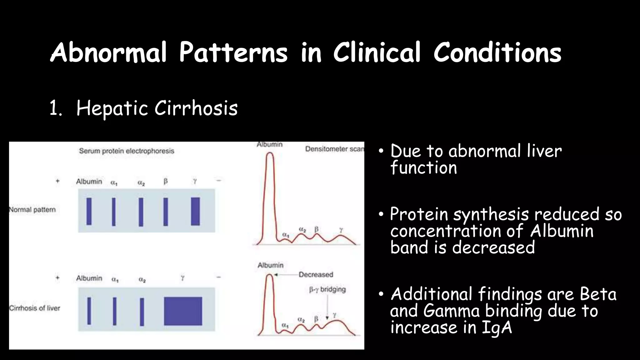Interpretation of Serum Electrophoresis | PPTX