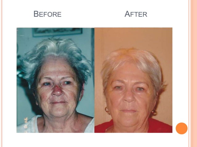 Electro Myopulse Therapy | PPTX