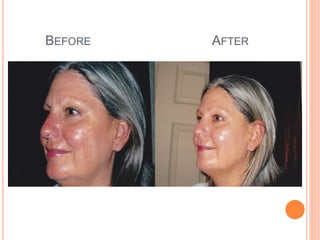 Electro Myopulse Therapy | PPTX