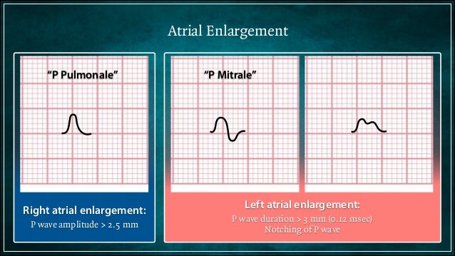 Electrocardiogram