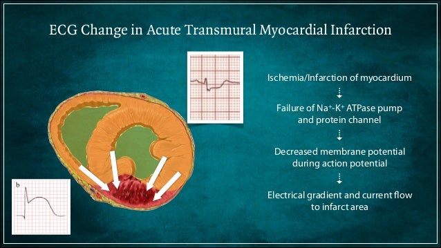 Electrocardiogram