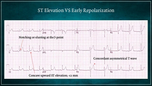 Electrocardiogram