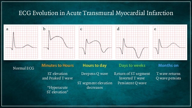 Electrocardiogram