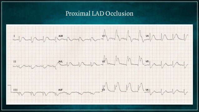 Electrocardiogram