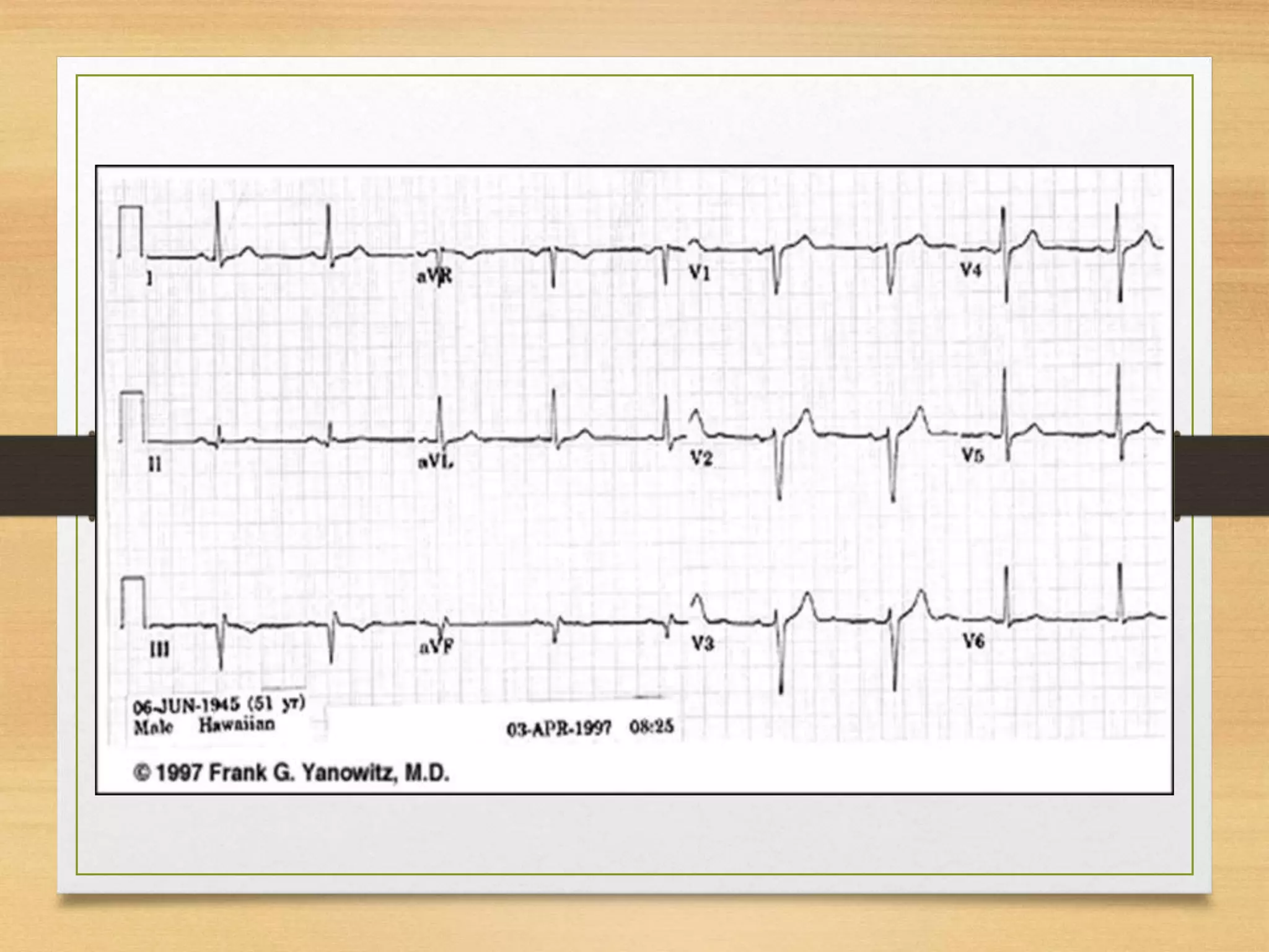 Electrocardiogram | PPTX